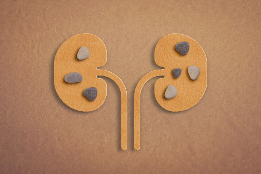 Pedra nos rins: saiba como prevenir e tratar o problema - O SERINGAL